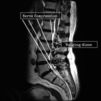 What is the difference between a bulging disc and a herniated disc?