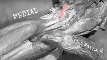 Sacrotuberous Ligament