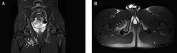 The Obturator externus